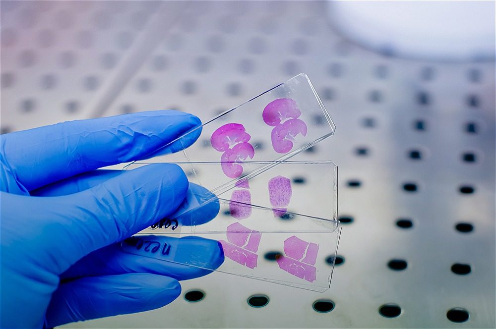 Vitro Dermatopathology | Miami Florida Dermatopathology Lab