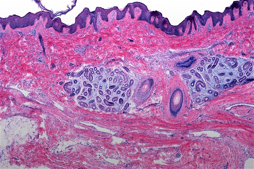 Vitro Dermatopathology | Miami Florida Dermatopathology Lab